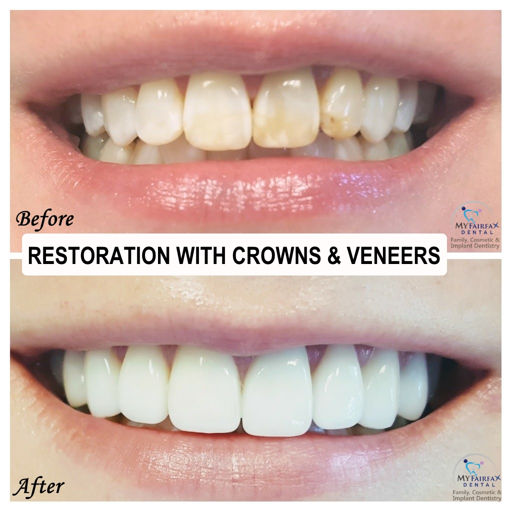 Smile Gallery - My Fairfax Dental - Family, Cosmetic and Implant ...